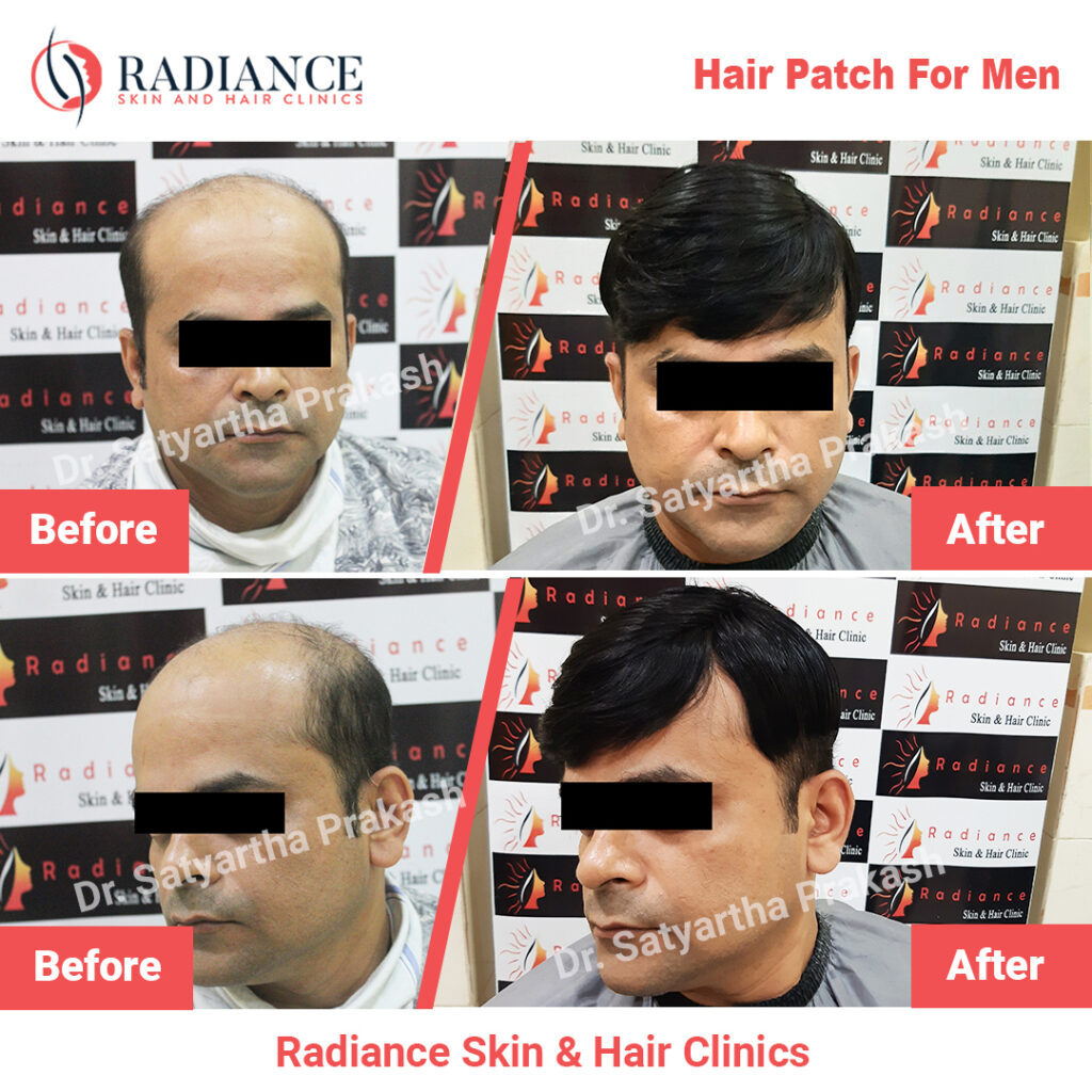 Hair Patch in Bhubaneswar | Radiance Skin & Hair Clinics