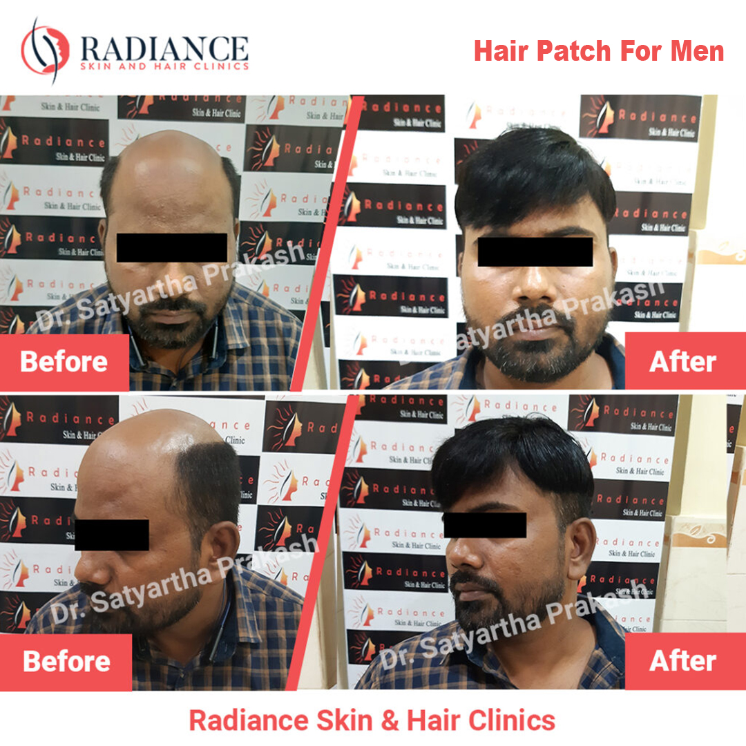 Hair Patch in Bhubaneswar | Radiance Skin & Hair Clinics